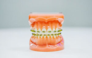 矯正治療で使うインプラントアンカー（TAD）って？ | 町田駅徒歩3分の歯医者 | 町田歯科・矯正歯科